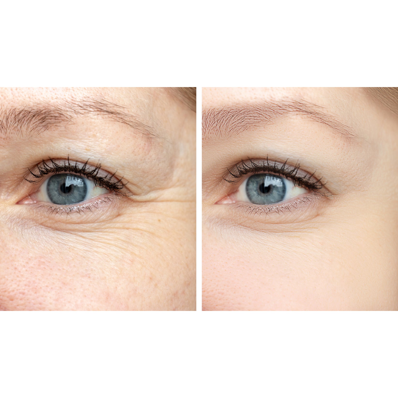 Neurotoxin Injections | Jennifer Baskin | Midwest Plastic Surgery ...