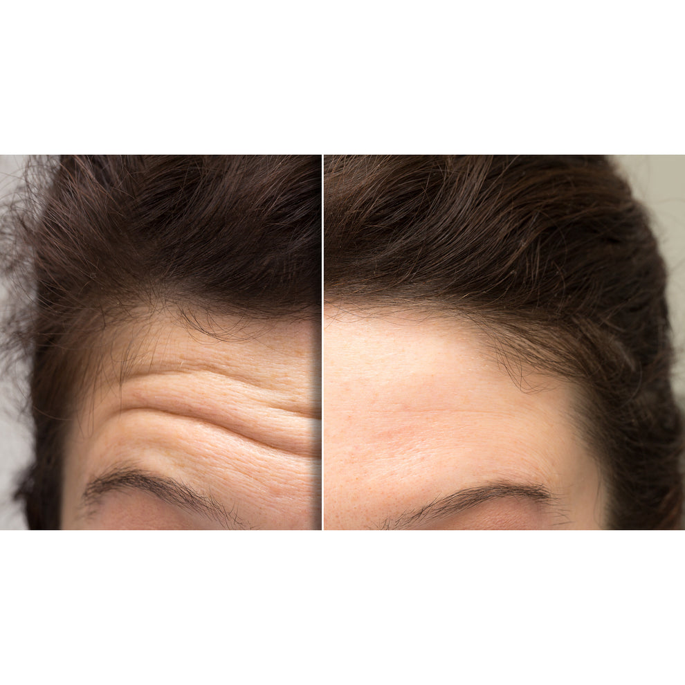 Neurotoxin Injections | Jennifer Baskin | Midwest Plastic Surgery ...